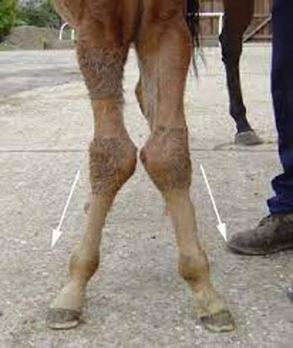 Angular Limb Deformities Flashcards Quizlet