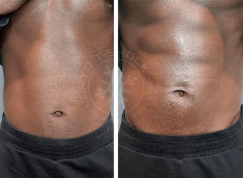 Before And After Gallery Icebox Cryotherapy Studios