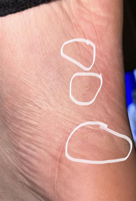 Are These More Burrows I Had Confirmed Scabies In October But They