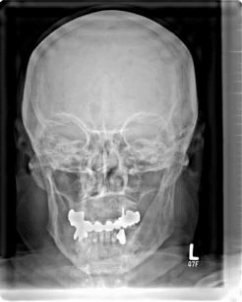 Skull Processed With Wavelet Pyramid And Linear Remapping Of Subbands