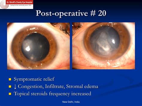 Ppt Late Diffuse Lamellar Keratitis In Post Lasik Infective Keratitis