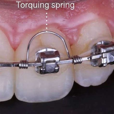 Promo Dental Torque Spring Universal Labial Lingual Root Torquing Ortho Diskon 23 Di Seller