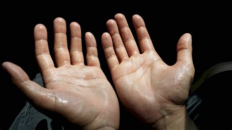 Hyperhidrosis Uk