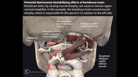 Can Botulinum Toxin Injections For Headaches Make Your Symptoms Worse