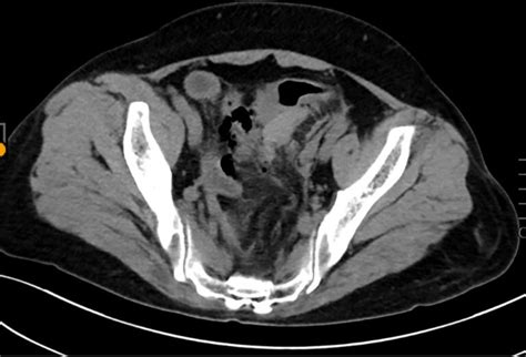 Sigmoid Colon Perforation With Surrounding Exudation Pneumatosis And Download Scientific