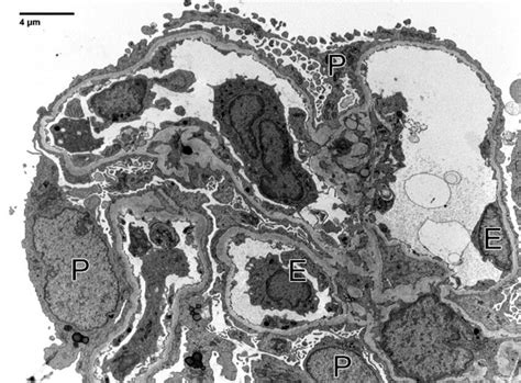 Electron Microscopy One Non Obsolescent Glomerulus Was Subjected To Download Scientific