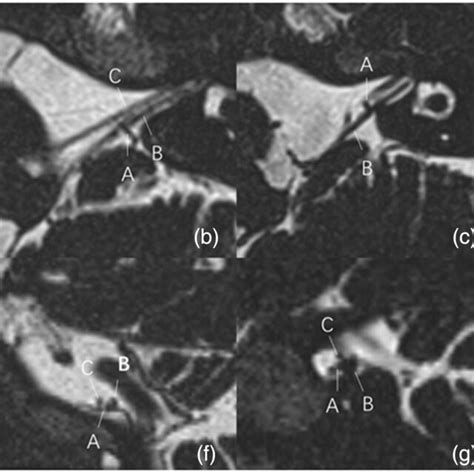 Chavda Classification Of Aica Loop A Type I Aica Loop Arrow Is Download Scientific Chavda Classification Of Aica Loop A Type I Aica Loop Arrow Is Download Scientific