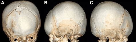 Three Dimensional Computed Tomographic Reconstruction At The Age Of 10