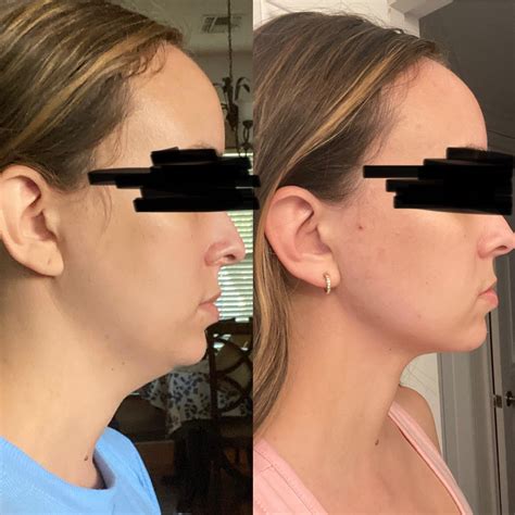2 5 Months Post Op Chin Lipo R Plasticsurgery
