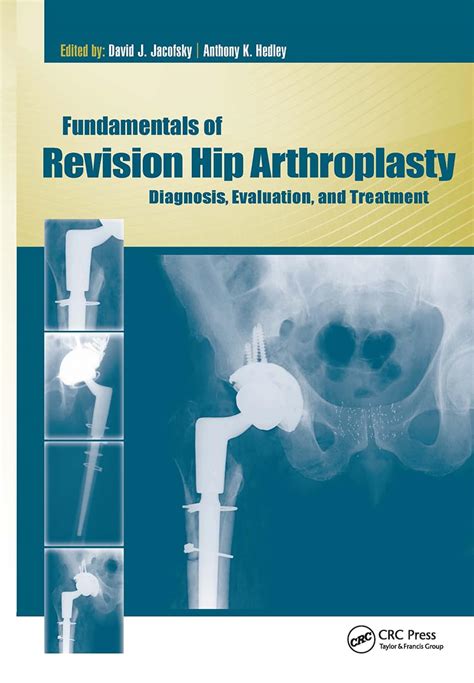 Fundamentals Of Revision Hip Arthroplasty Diagnosis Evaluation And Treatment Orthopedics