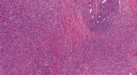 Dermatofibroma Ottawa Atlas Of Pathology