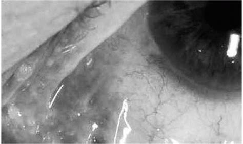 Cicatrizing Conjunctivitis Ento Key