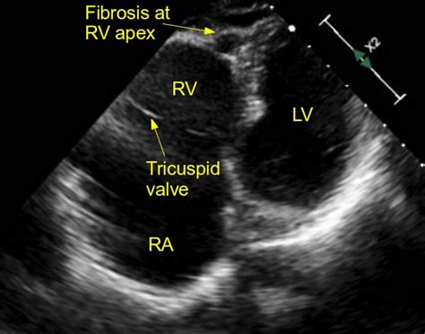 Multiple Echo Views In Emf Dilated Rvot Rv Apical Dimple And Fibrosis