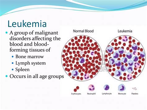 Leukemia Pptx