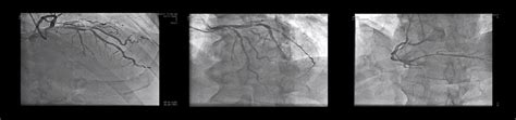 Video Lad Diagonal Bifurcation Lesion