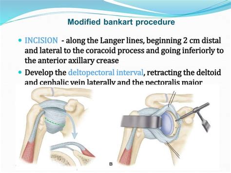 Recurrent Shoulder Dislocation Ppt