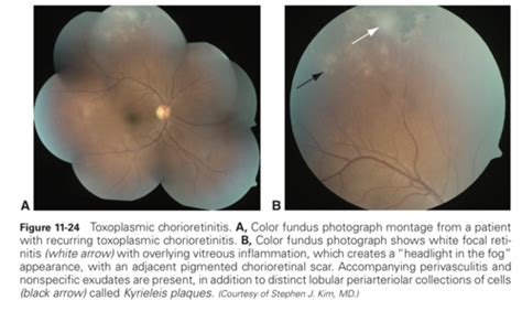Fichas De Aprendizaje Infectious Retinal And Choroidal Inflammation Parasite Quizlet