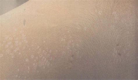 硬化萎缩性苔藓 临床实用皮肤病性病图谱 医学
