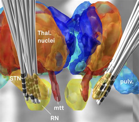 Lead Dbs A Matlab Toolbox Facilitating Reconstruction And Visualization Of Dbs Electrodes