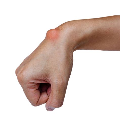Cyst Removal Eldon Aesthetics Providing Cyst Removal