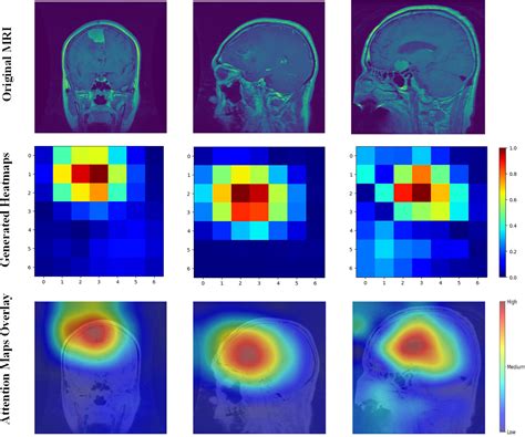 Enhancing Brain Tumor Mri Classification With An Ensemble Of Deep Learning Models And