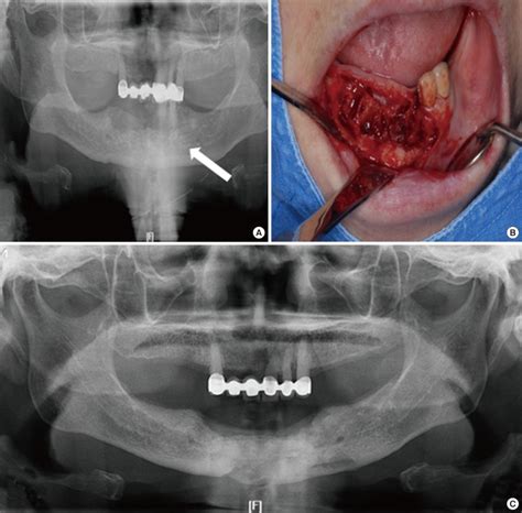 A The Dental Panoramic View Demonstrates Osseous Sclerosis Arrow