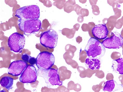 Figure S2 Cytochemistry Top Blasts Were 100 Positive For Download Scientific Diagram