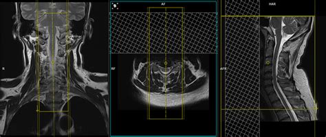 Csf Flow Chiari I Malformation Mri Chiari I Malformation Mri Protocol And Planning