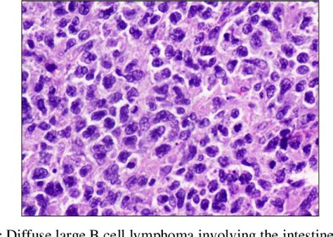Figure 1 From Telescoping Intestines Intussusception In Adults