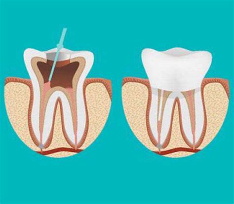 Root Canal Treatment Clinic In Jodhpur Root Canal Services In India