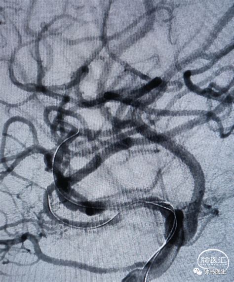 中枢介入第363期：大脑中动脉三叉口狭窄微导丝保护扩张支架置入 脑医汇