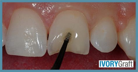 Dentin Bonding Agents Ivory Graft