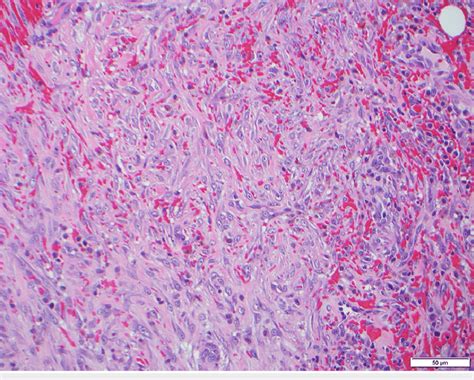 Extensive Hemorrhage With Hemosiderin Deposition Composed Of A Download Scientific Diagram