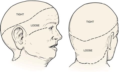 24 Reconstruction Of The Scalp Pocket Dentistry