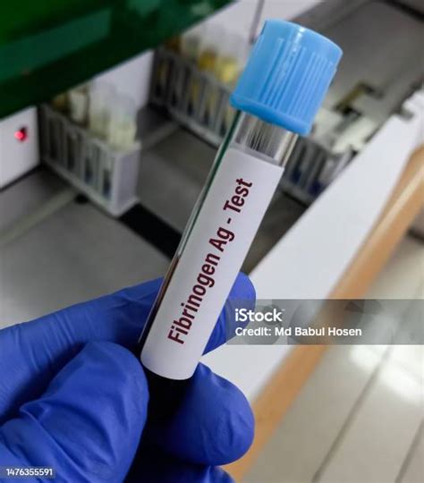 Scientist Hold Blood Sample For Fibrinogen Ag Test To Diagnosis Of