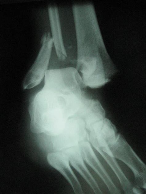 Fracture Fibula The Of Proximal Fibula Fracture Ingl