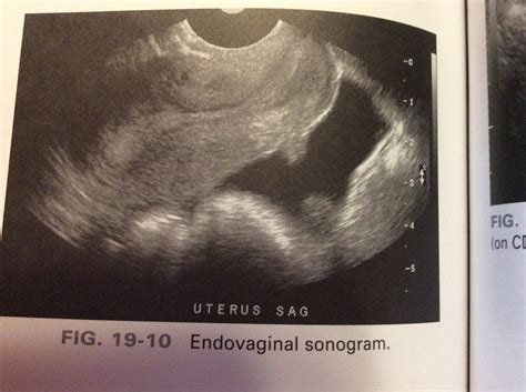Space Of Retzius Ultrasound