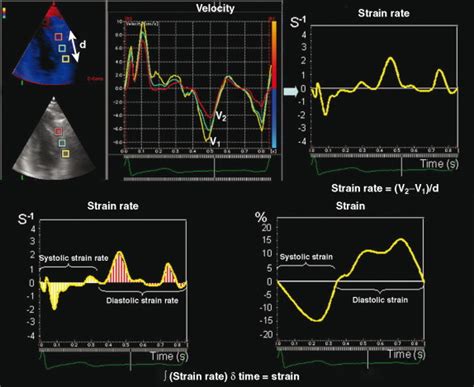 Evaluation Of Diastolic Function By Tissue Doppler Strain And Torsion
