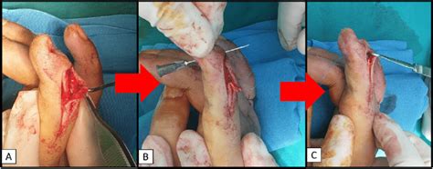 Steps Of Terminal Extensor Tendon Reconstruction A Approach To The