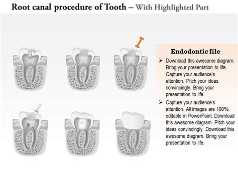 Illustration Of Root Canal Procedure Of Tooth PowerPoint Presentation Sample Example Of