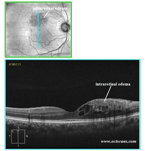 Retinal Vein Occlusion Optical Coherence Tomography Scans