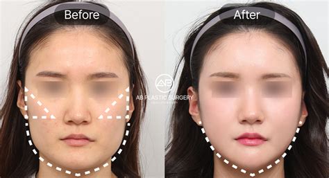 Facial Contour Surgery In South Korea Techniques Benefits And