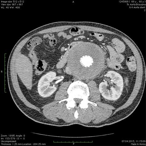 A Patient With Renoureteral Subtype Of Retroperitoneal Fibrosis A