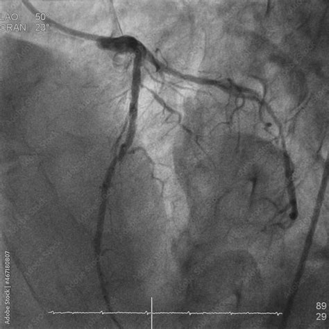 Coronary Angiogram Cag Was Performed Left Anterior Descending Artery