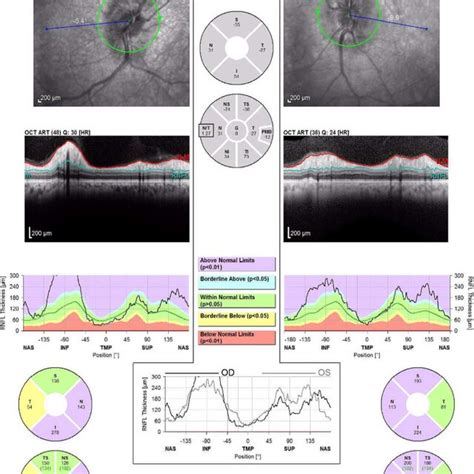 Mri Of The Orbits Shows Thickened Optic Nerve With Increased T2 Signal Download Scientific