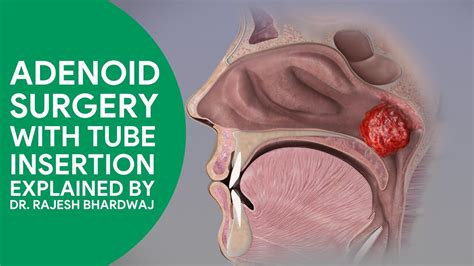 Adenoidectomy Before And After