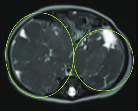 Bilateral Ewing Sarcoma Primitive Neuroectodermal Tumor Axial T2 Haste