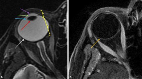 Globe Anatomy Axial T2wi A And Axial T1 Post Contrast Fat Download Scientific Diagram