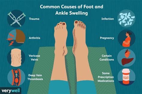Why Is My Foot And Ankle Swollen Cause And Treatments