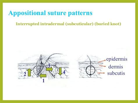 Basic Suture Patterns
